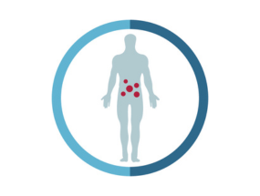 Gastro-intestinale stromaceltumor; symptomen, onderzoek en behandeling ...