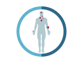 Basaalcelcarcinoom: symptomen, onderzoek en behandeling ...